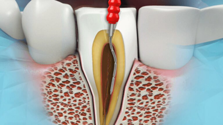 Painless Root Canal Treatment in North Delhi | Cost of Root Canal Delhi ...