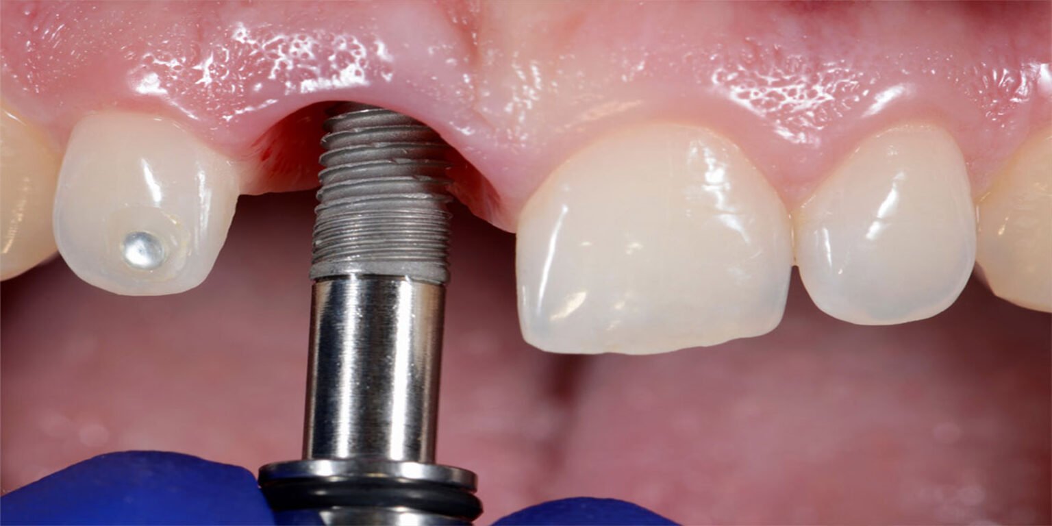 RCT vs Implants - Which Treatment Is Right for You? - Dr Ankita's North ...